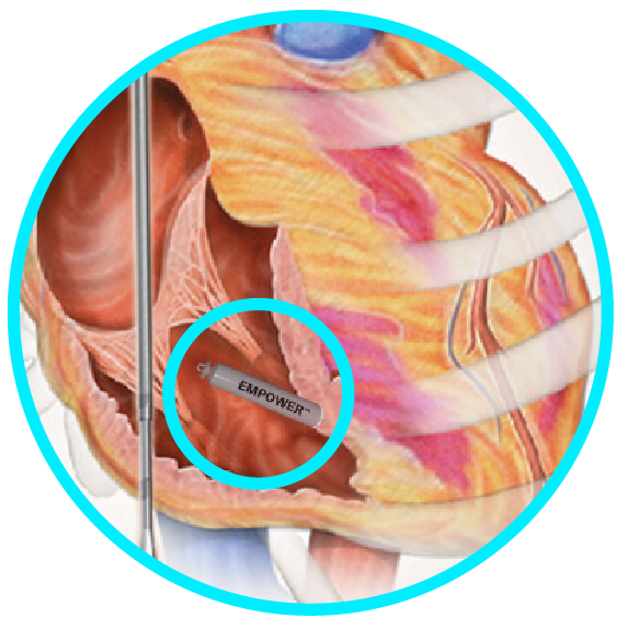 APPRAISE, MODULAR Trials - EMBLEM MRI S-ICD System - Boston Scientific - Boston Scientific